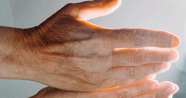 Compensation For Dupuytren’s Contracture | Claim For 'Claw Hand'